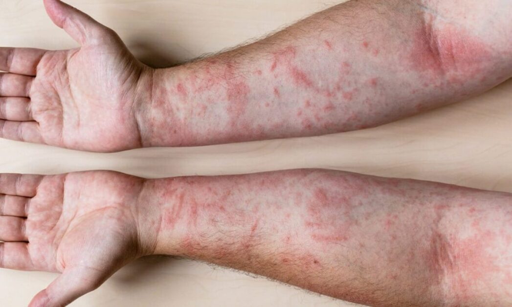 Skin Rash. What to do in 2024. - Medspurs