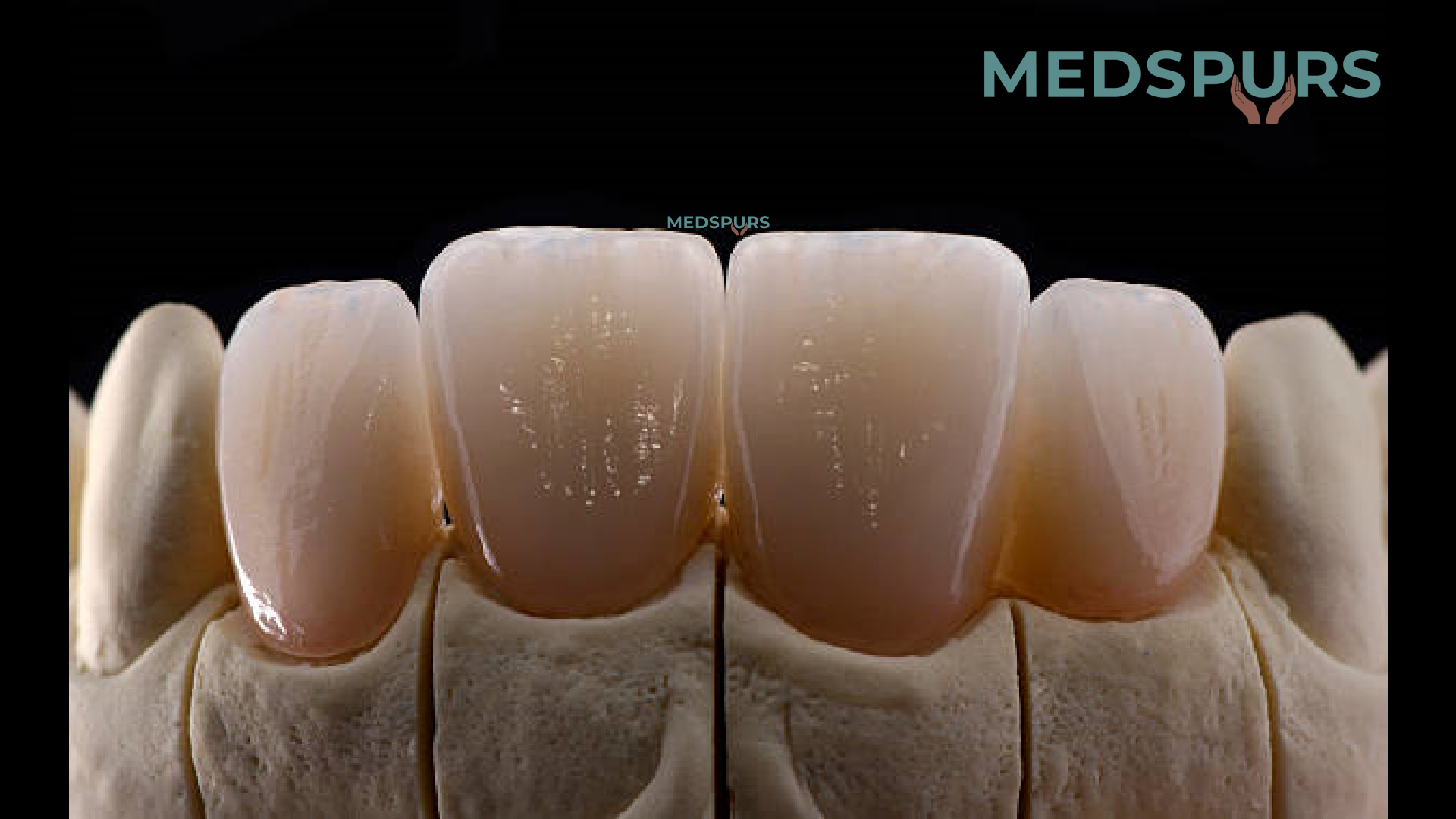 Prosthodontics 101: The secrets to a perfect smile in 2024! - Medspurs