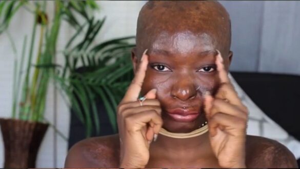 How to Treat 4th Degree Burns In 2024. - Medspurs